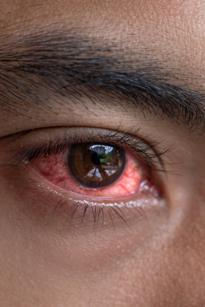 Uveíte: o que é, causas e sintomas. – Alpha Diagnose Oftalmologia